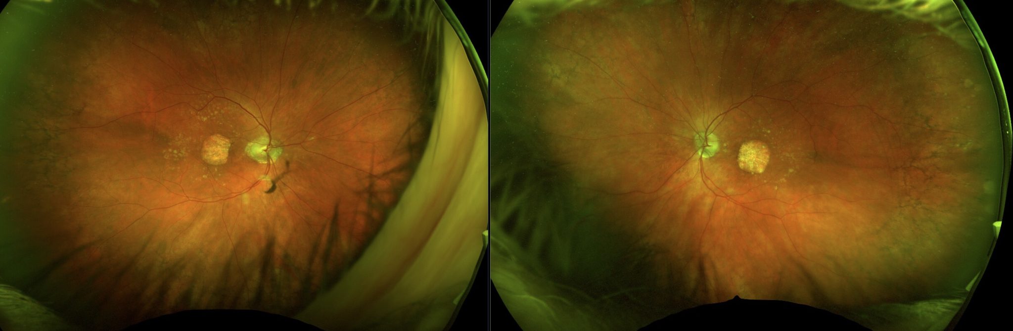 What is Age-Related Macular Degeneration? - New England College of ...