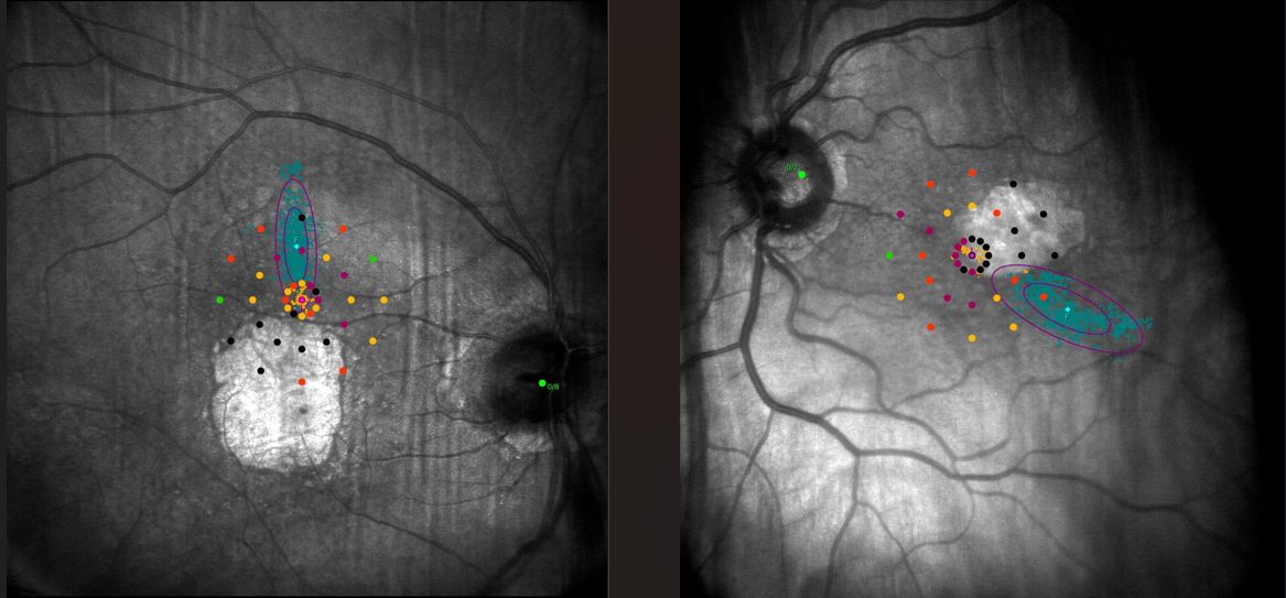What is Age-Related Macular Degeneration? - New England College of ...