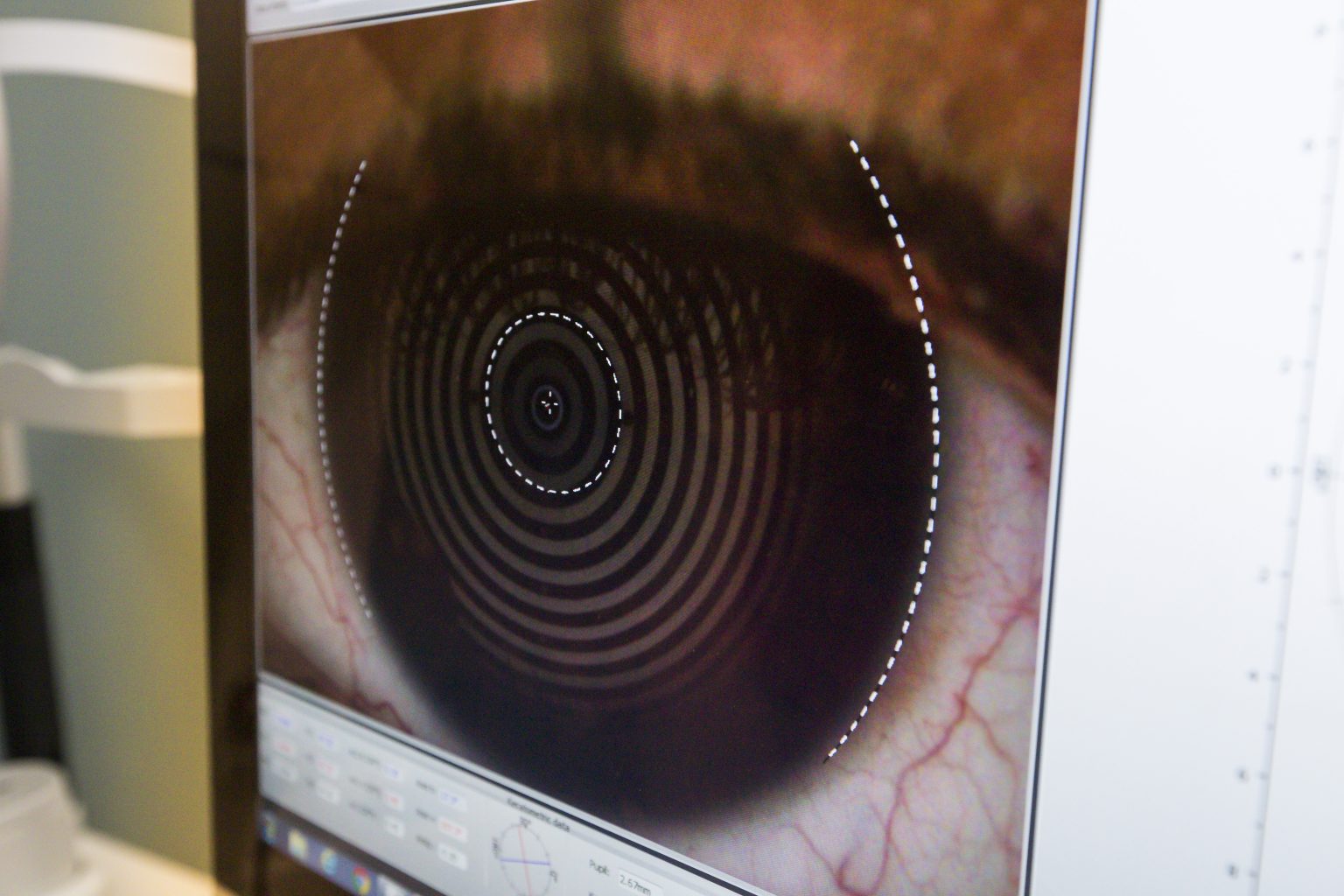 Understanding and Managing Dry Eye - New England College of Optometry
