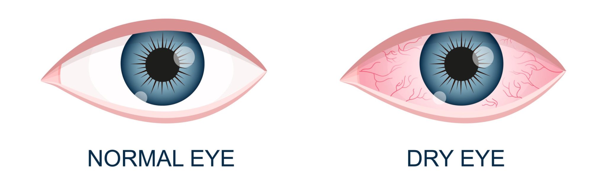 Ocular Surface Disease 101: Dry Eye Workup with TBUT, MGD Grading ...