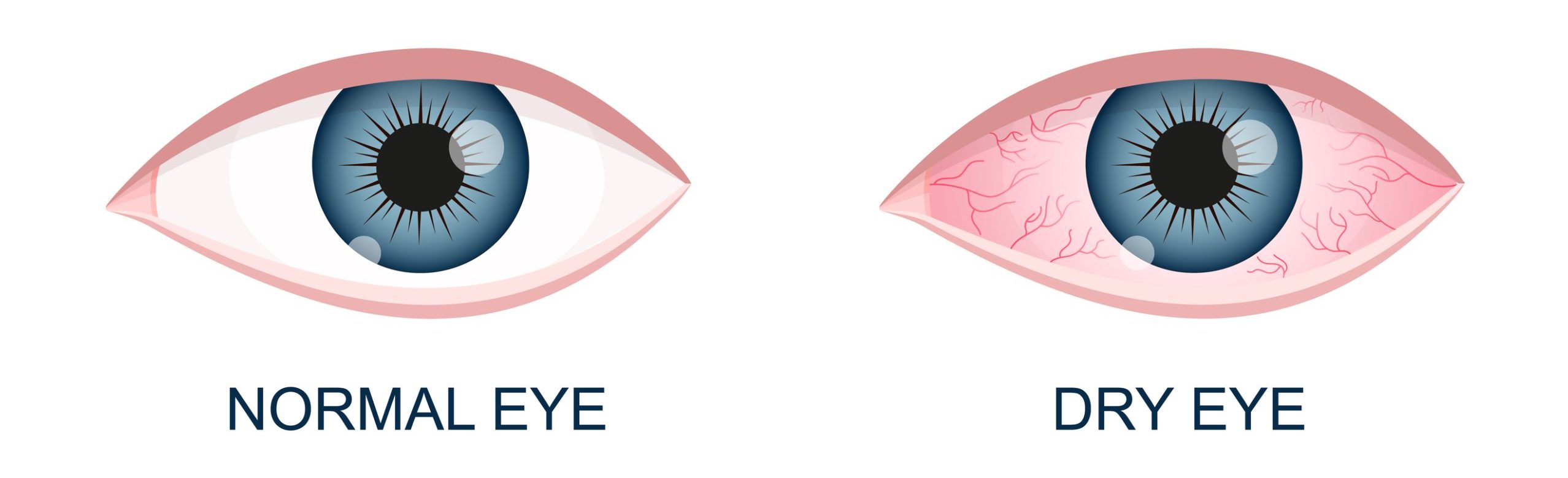 Ocular Surface Disease 101: Dry Eye Workup with TBUT, MGD Grading ...